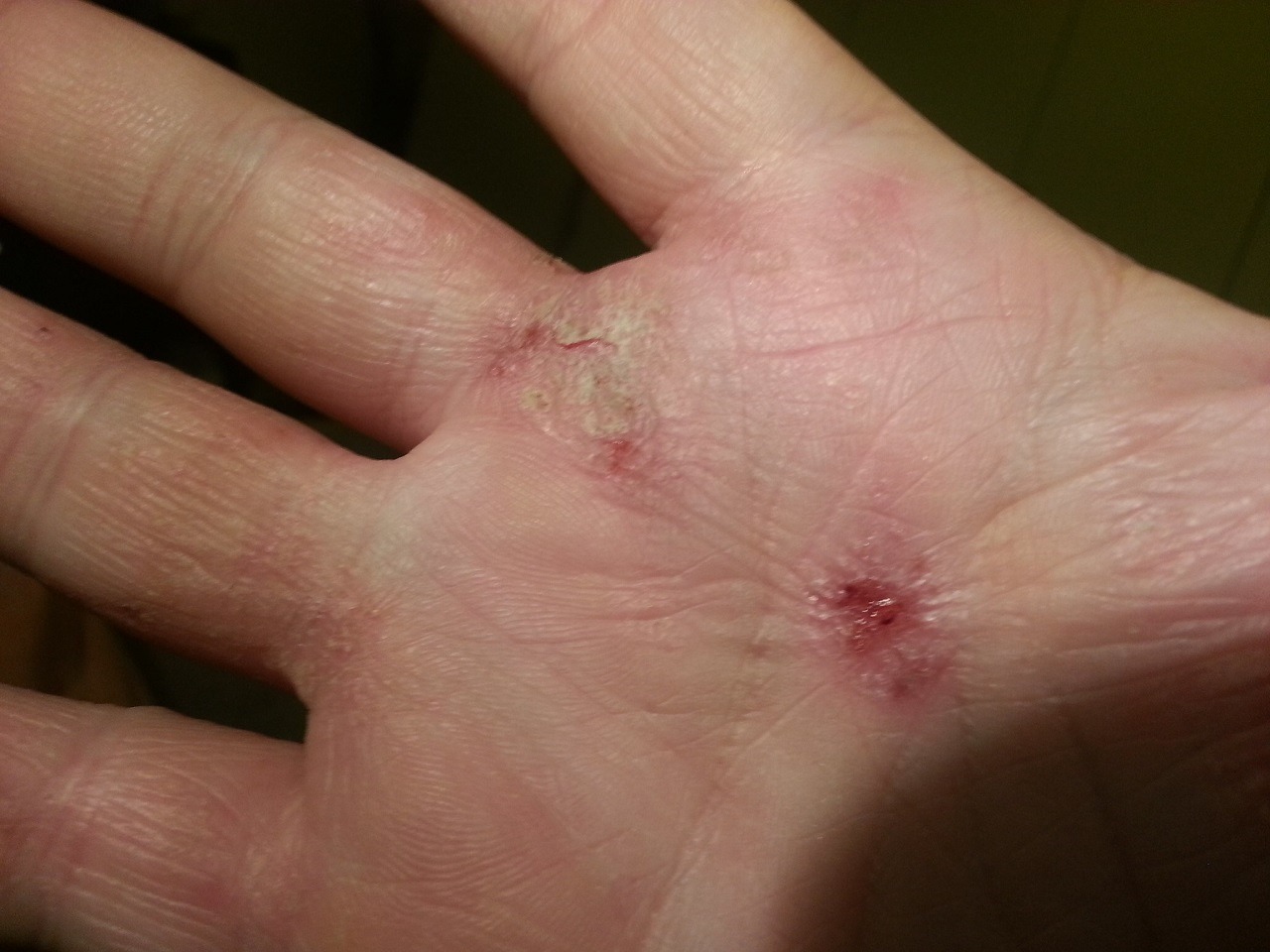 European Commission approves AbbVie's Rinvoq for atopic dermatitis